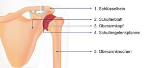Schulterarthrose: Überblick | Arthrose